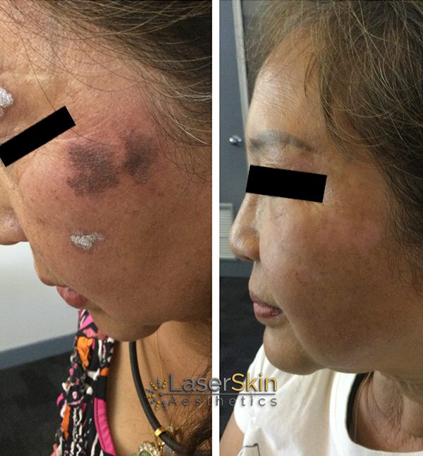 Laser Pigmentation Removal - Laser Skin Aesthetics