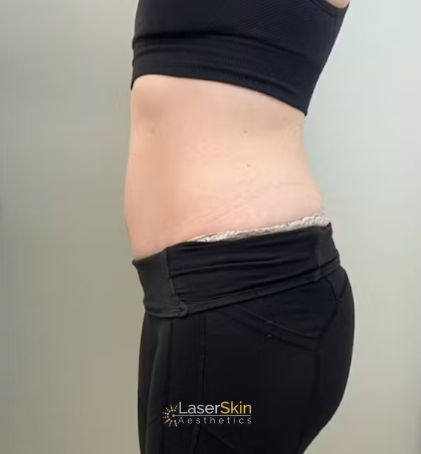 Body Contouring – Laser Skin Aesthetics