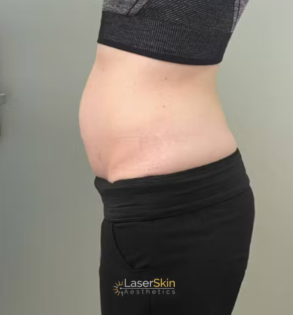 Body Contouring – Laser Skin Aesthetics