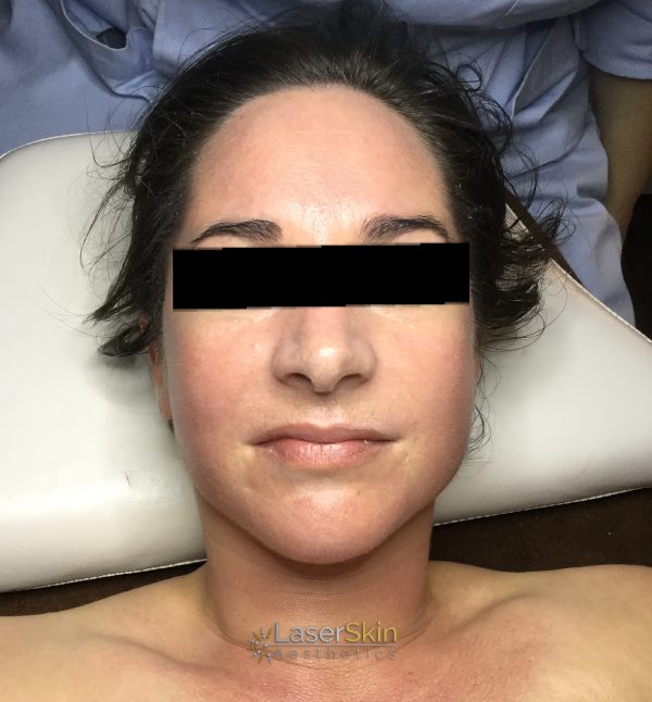Laser Pigmentation Removal - Laser Skin Aesthetics