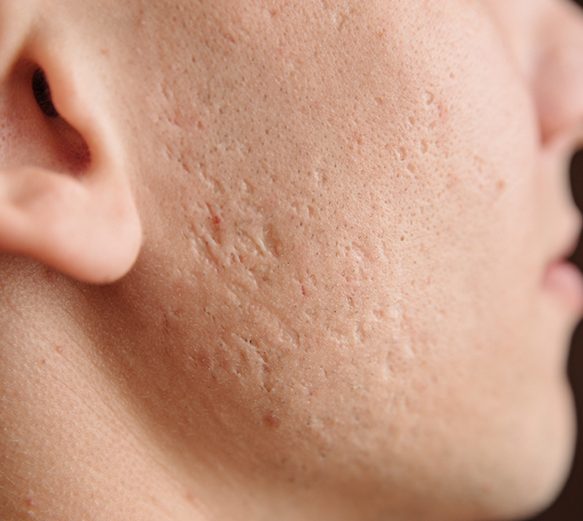 Scarring - Common Skin Concerns | Laser Skin Aesthetics