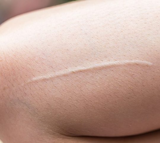 Scarring - Common Skin Concerns | Laser Skin Aesthetics