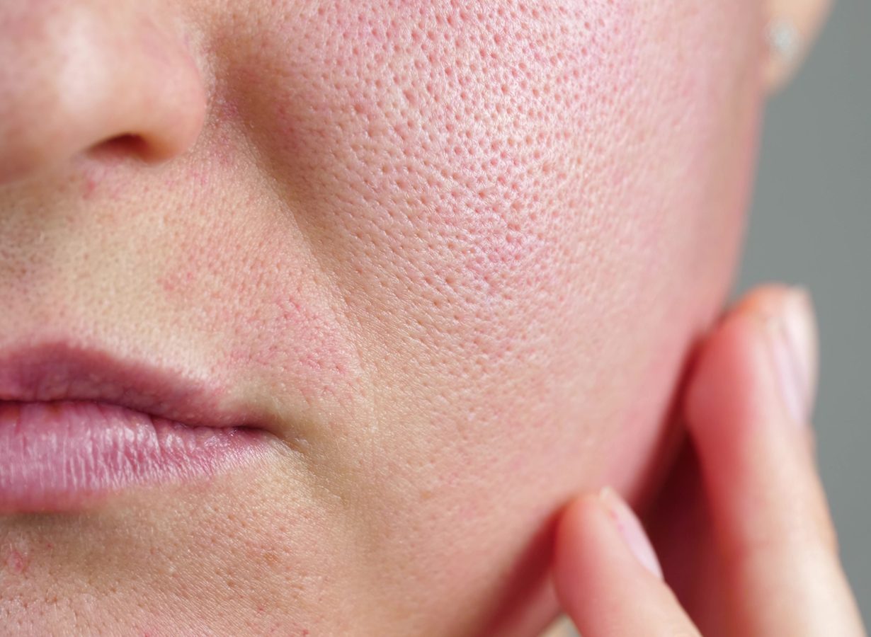 The Skin Aesthetics Insider - How to Get Rid of Enlarged Pores