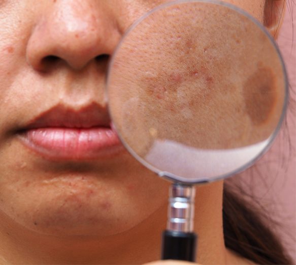 Pico Laser Treatments - Laser Skin Aesthetics West Perth